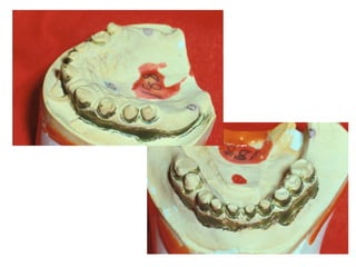 5-over denture new removable prosthodontics .ppt