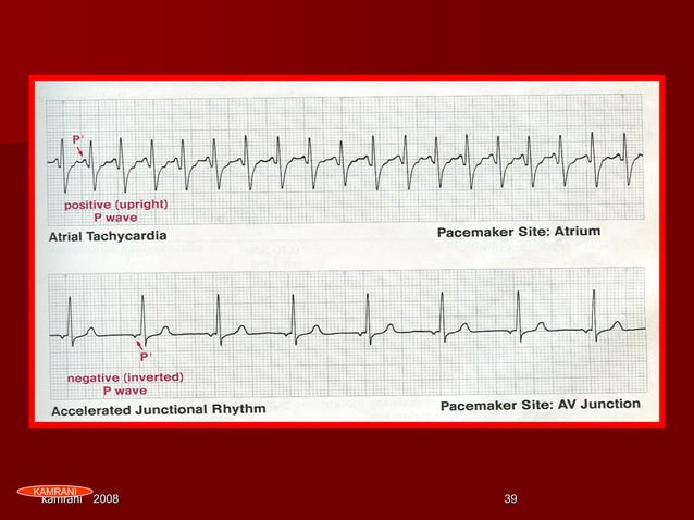 parameters of ekg interpretation-3 | PPT | Free Download