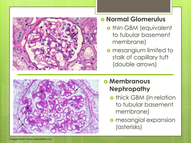 Pathophysiology of Membranous GN | PPT