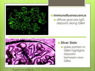 Pathophysiology of Membranous GN | PPT
