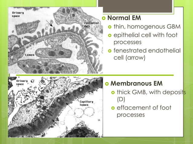 Pathophysiology of Membranous GN | PPT
