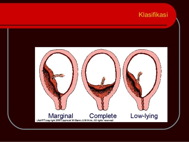 5 perdarahan antepartum