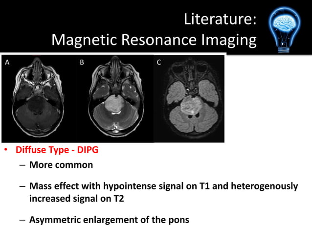 (Pediatric) Diffuse Intrinsic Pons Glioma | PPT