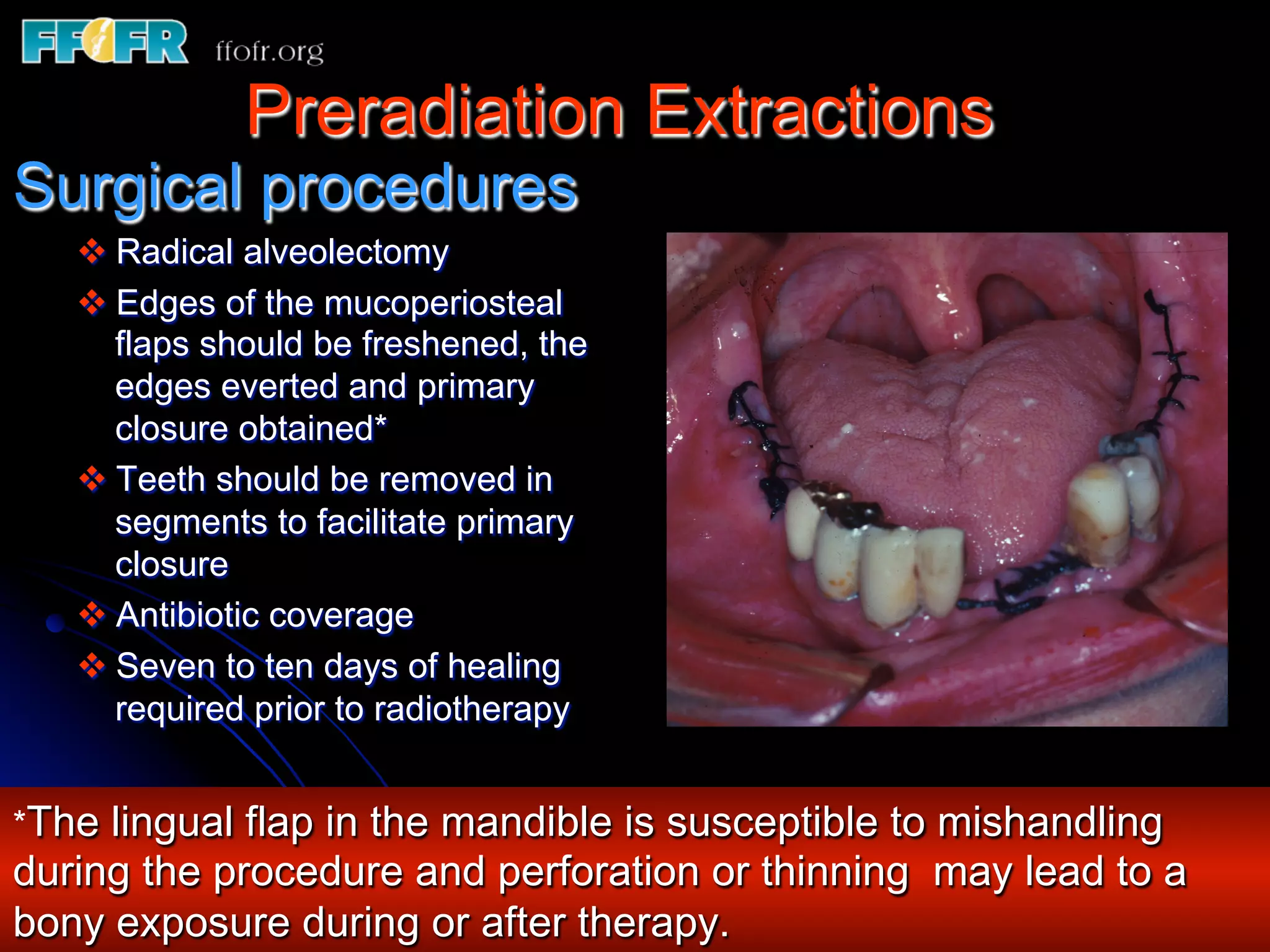 5.preradiation dental assessment | PDF