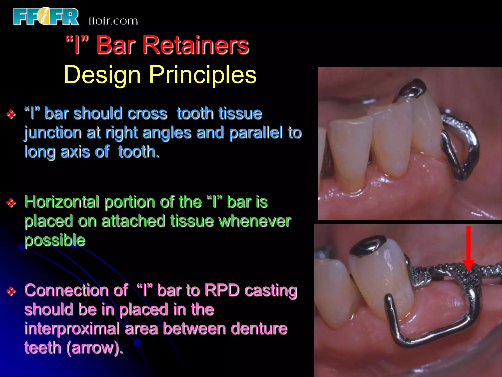 5.retainers, clasp assemblies and indirect retainers | PPT