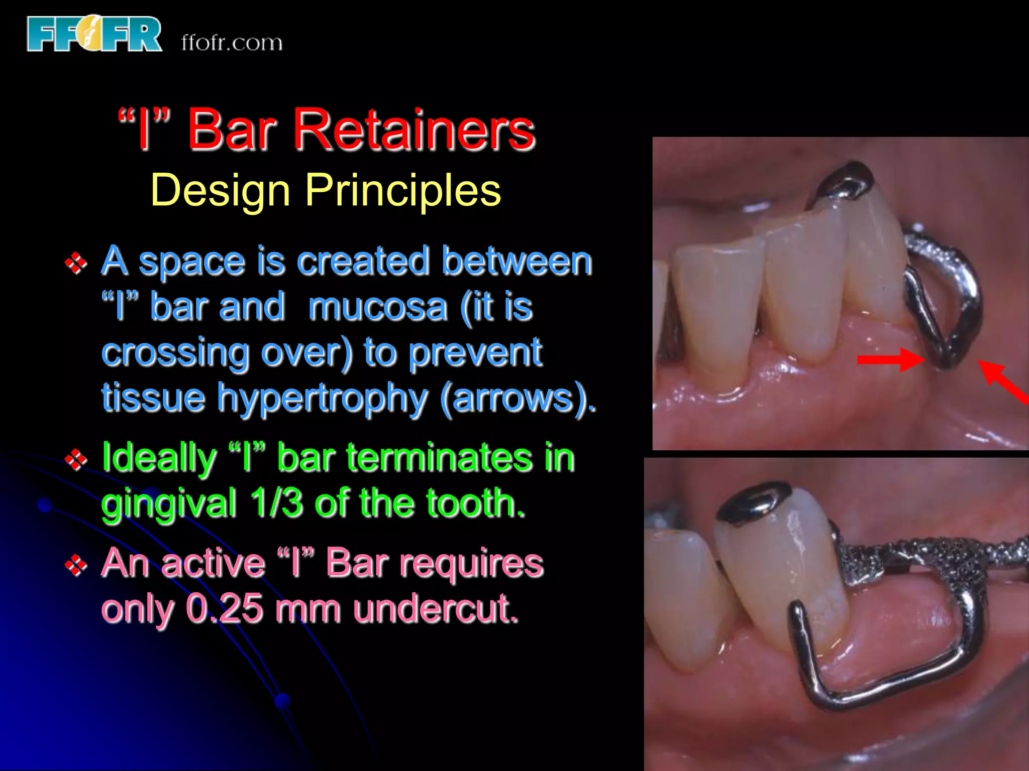 5.retainers, clasp assemblies and indirect retainers | PPT