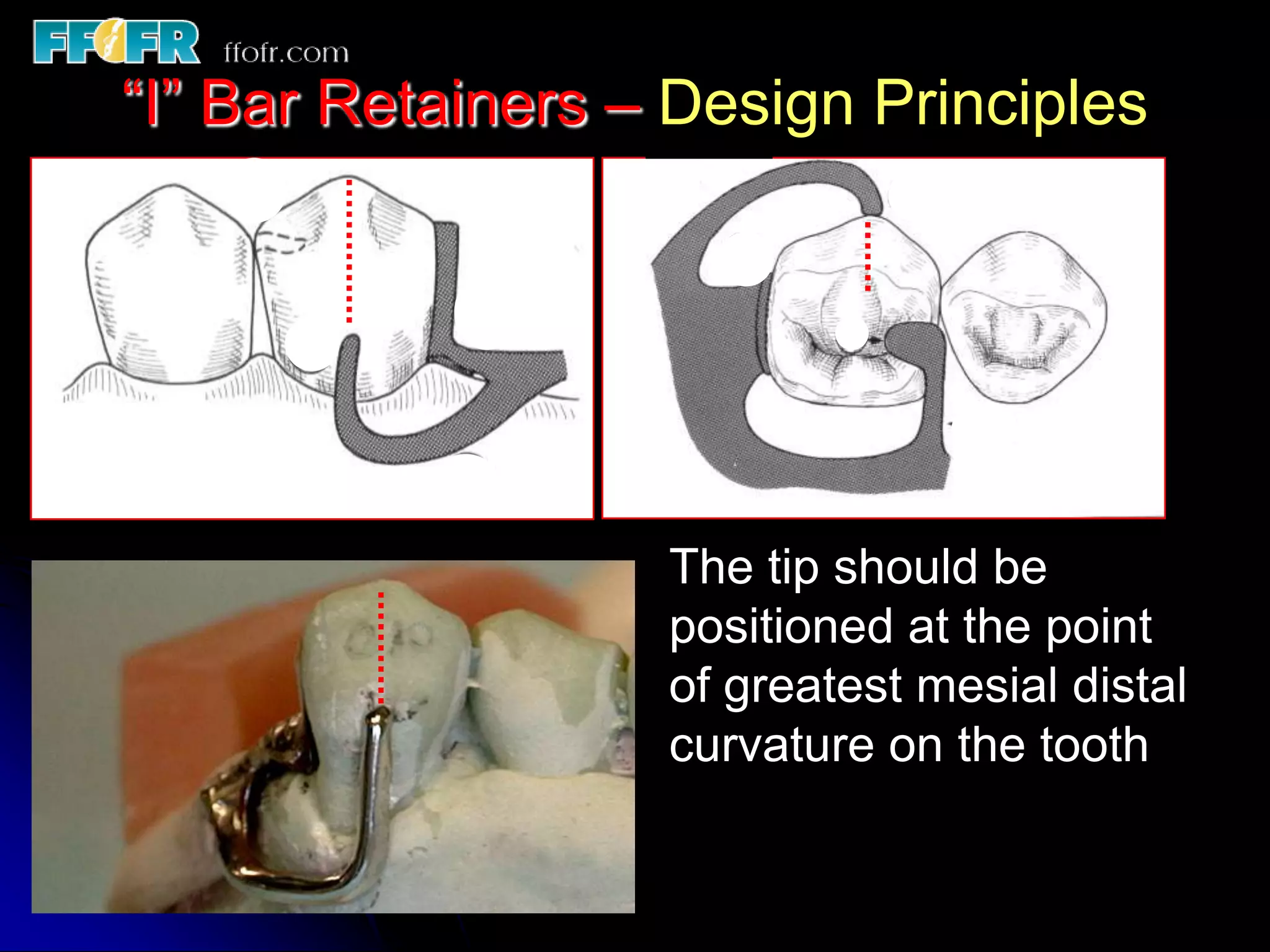 5.retainers, clasp assemblies and indirect retainers | PPT