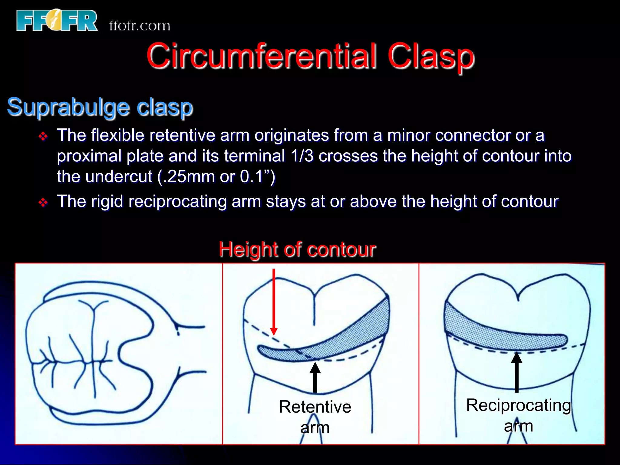 5.retainers, clasp assemblies and indirect retainers | PPT
