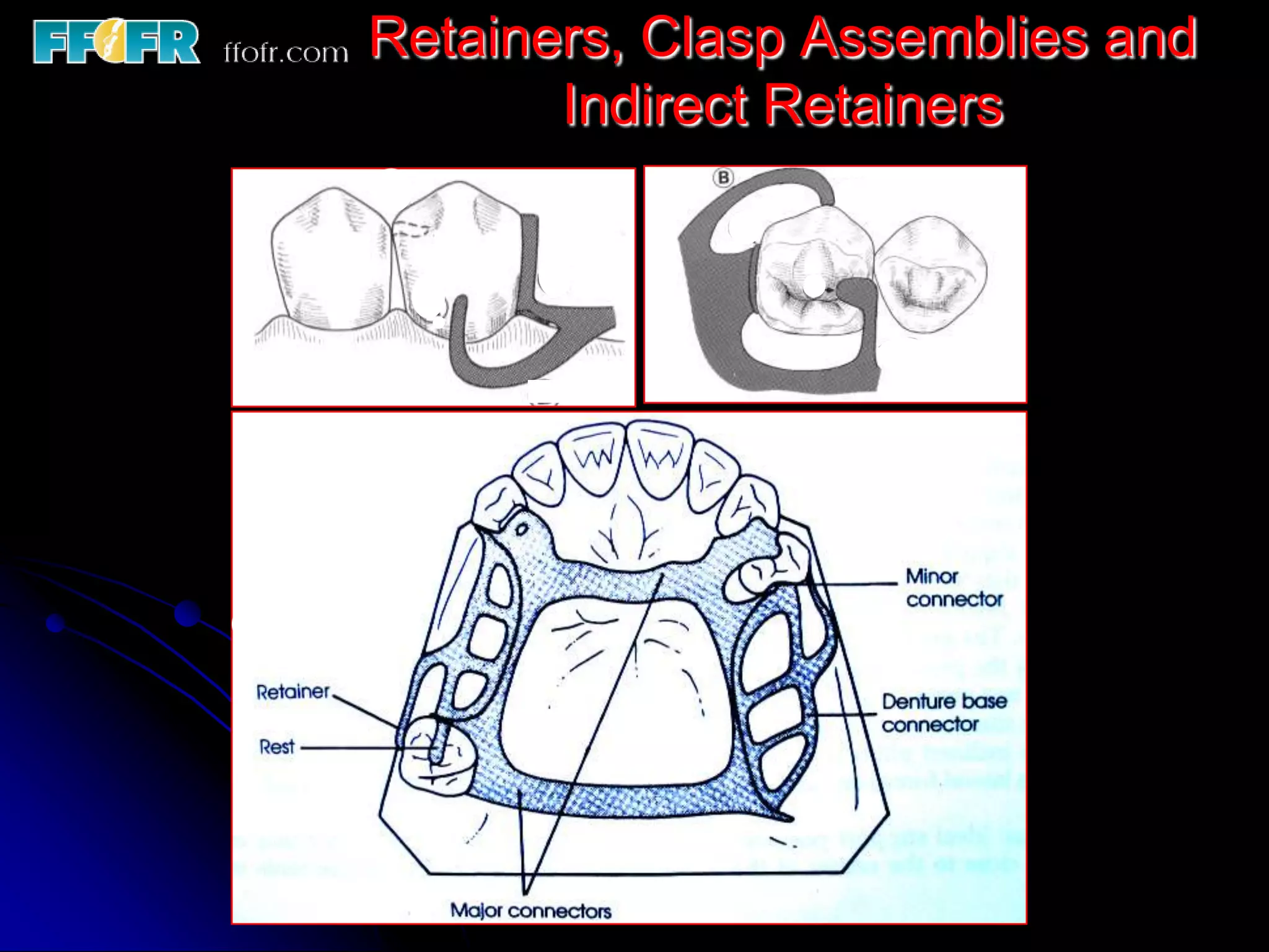5.retainers, clasp assemblies and indirect retainers | PPT
