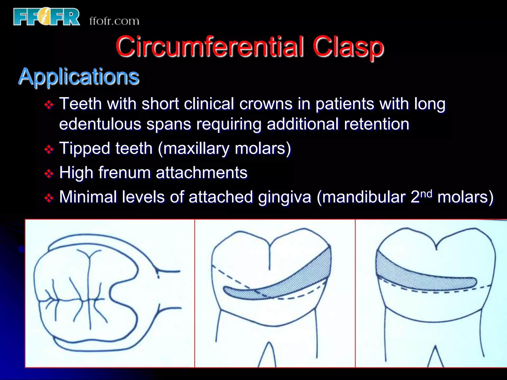 5.retainers, clasp assemblies and indirect retainers | PPT