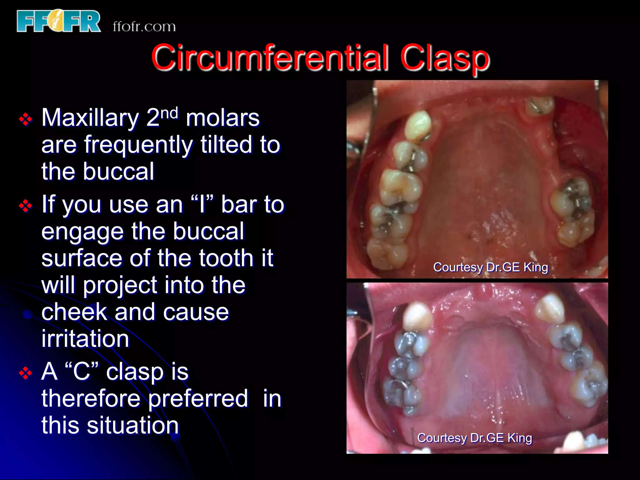 5.retainers, clasp assemblies and indirect retainers | PPT