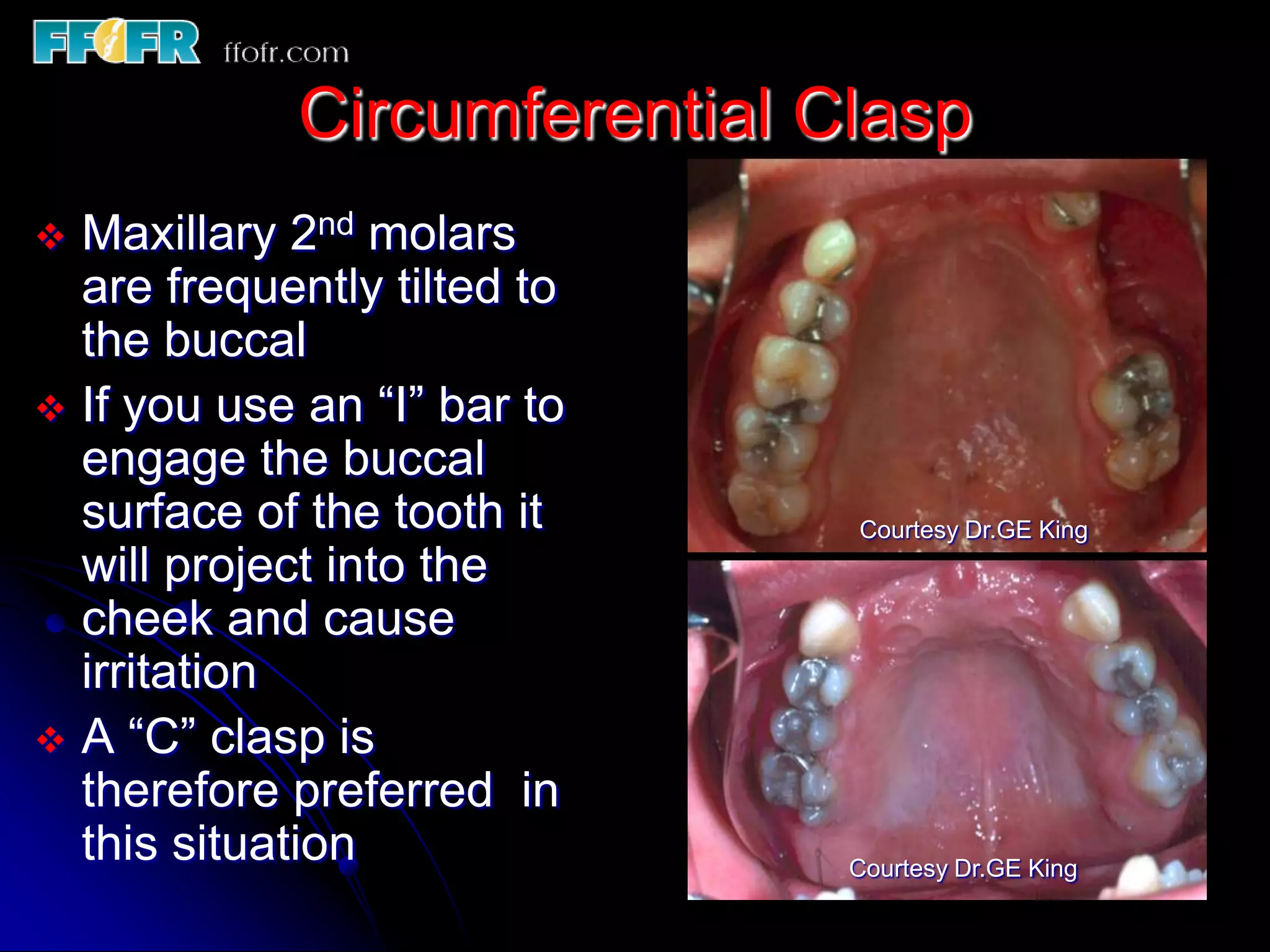 5.retainers, clasp assemblies and indirect retainers | PPT