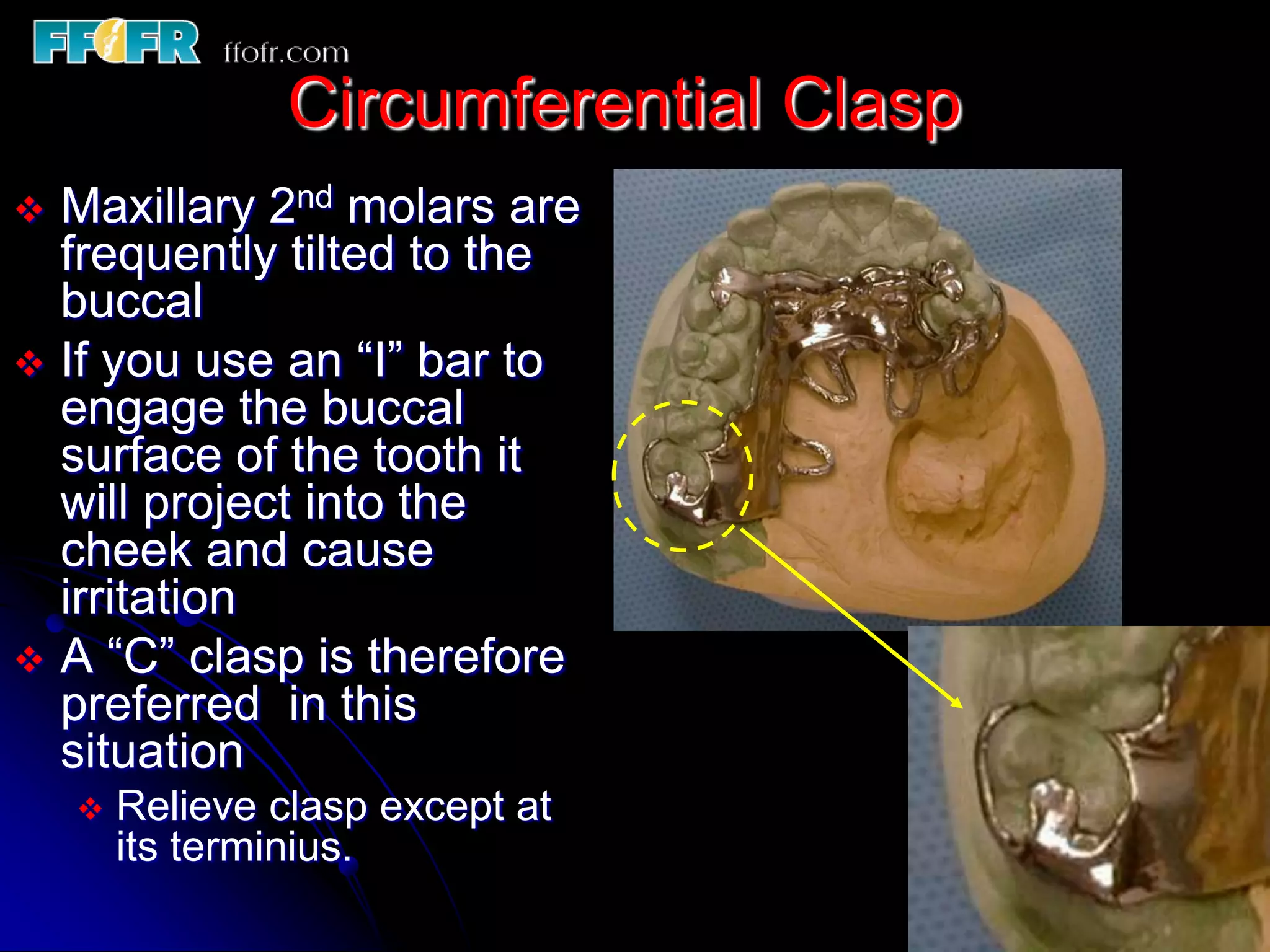 5.retainers, clasp assemblies and indirect retainers | PPT