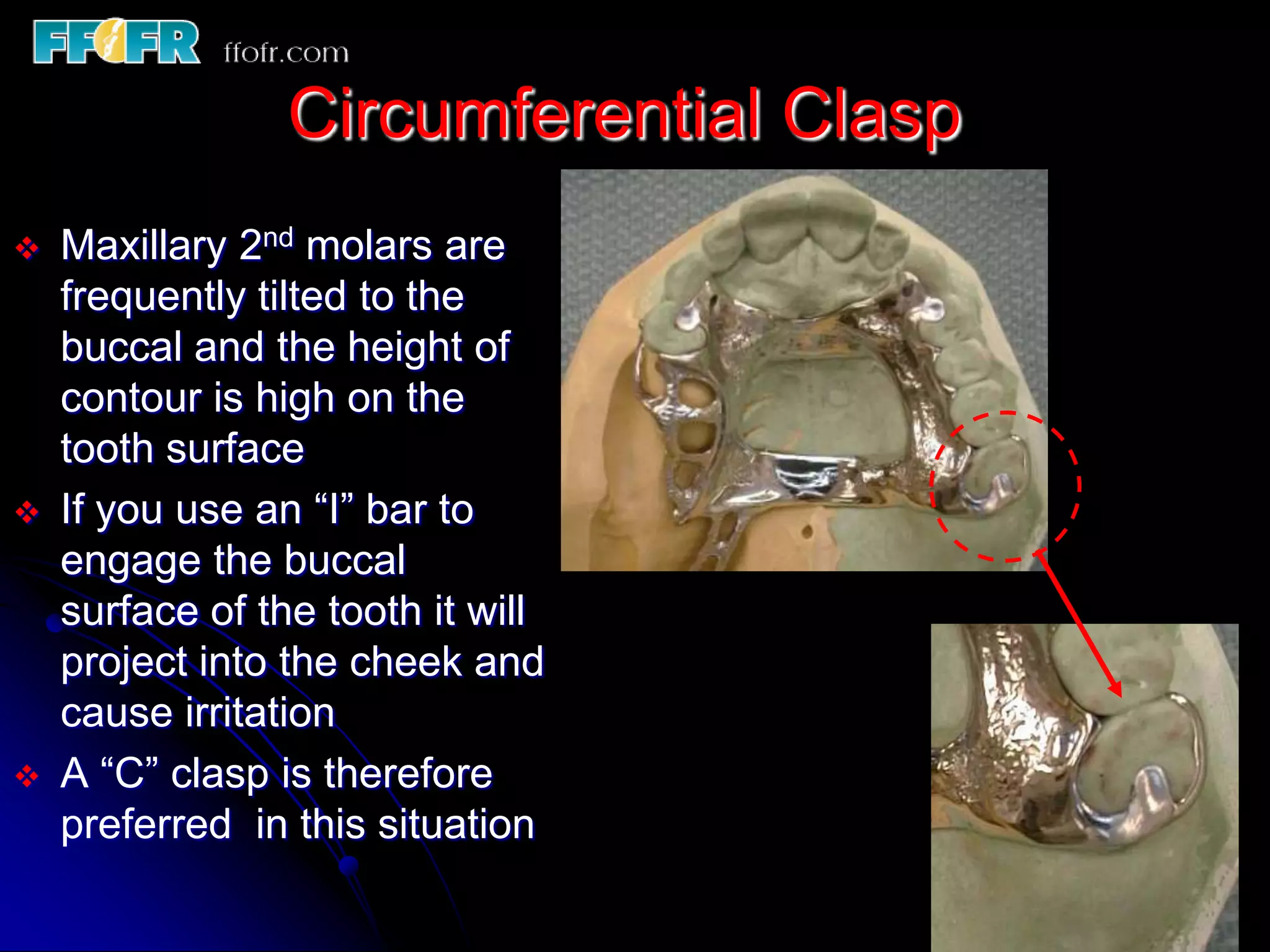 5.retainers, clasp assemblies and indirect retainers | PPT