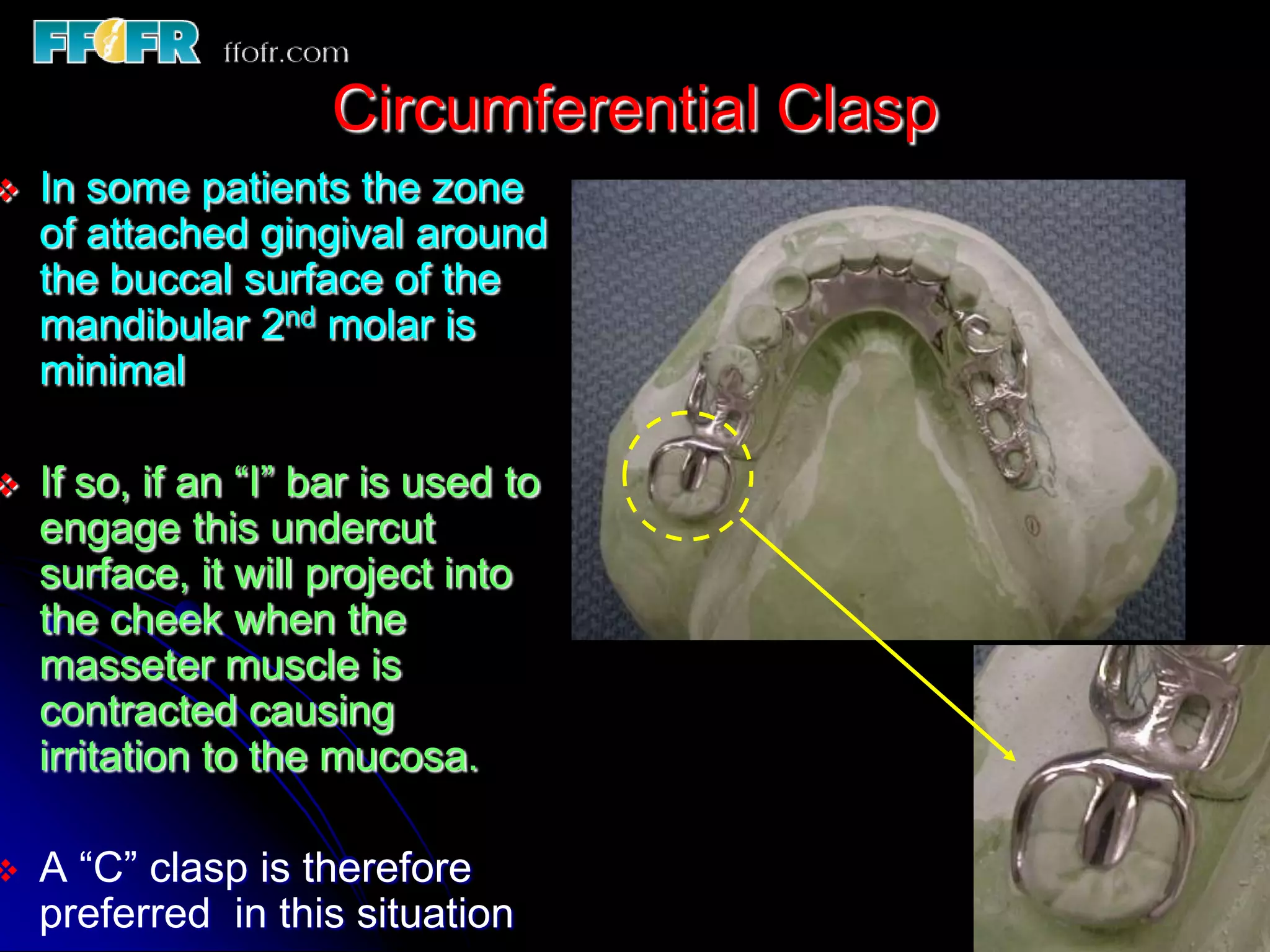 5.retainers, clasp assemblies and indirect retainers | PPT