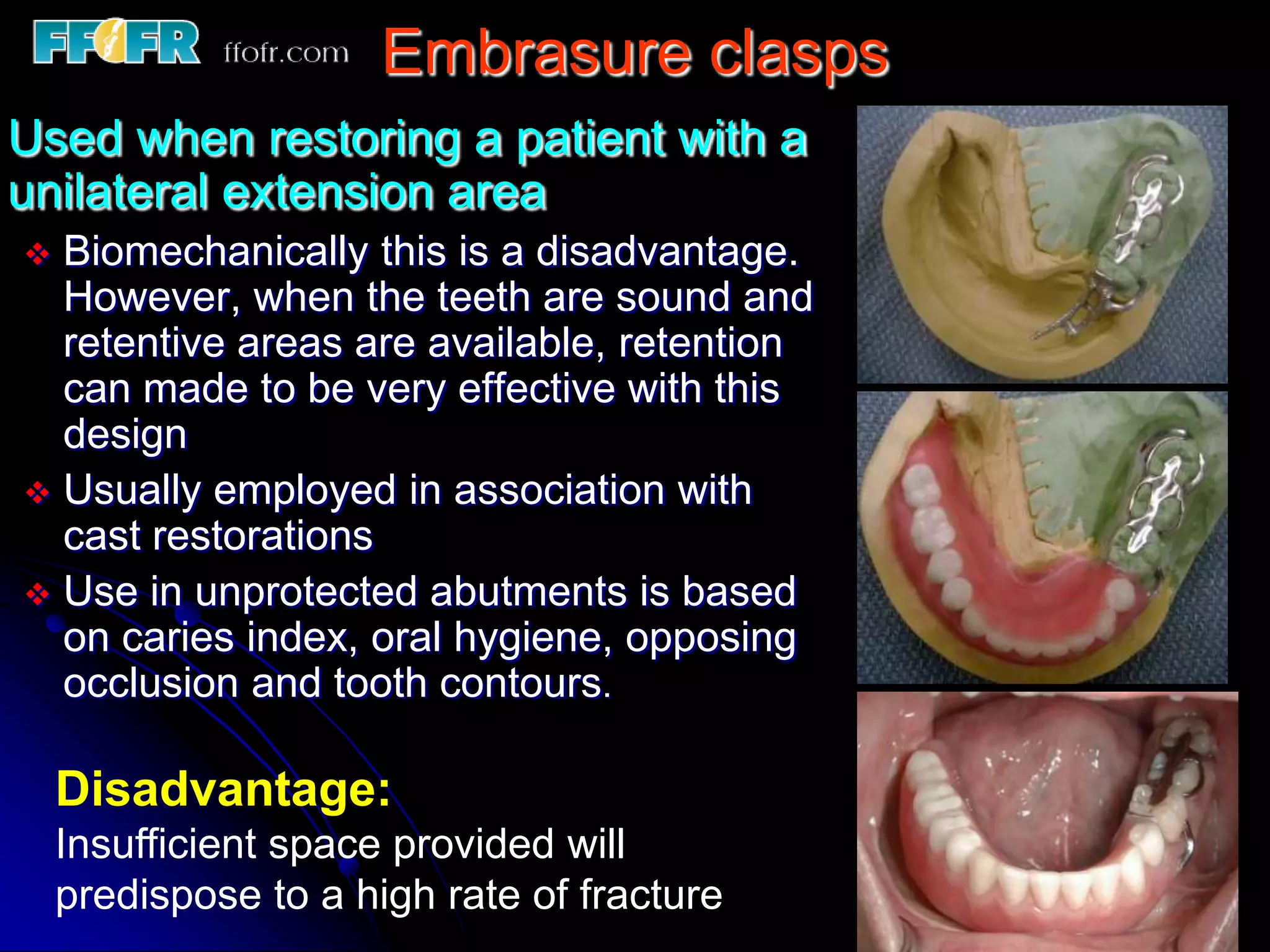5.retainers, clasp assemblies and indirect retainers | PPT