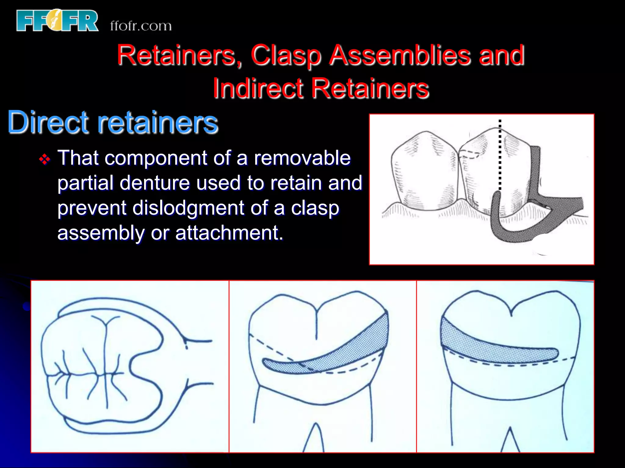 5.retainers, clasp assemblies and indirect retainers | PPT