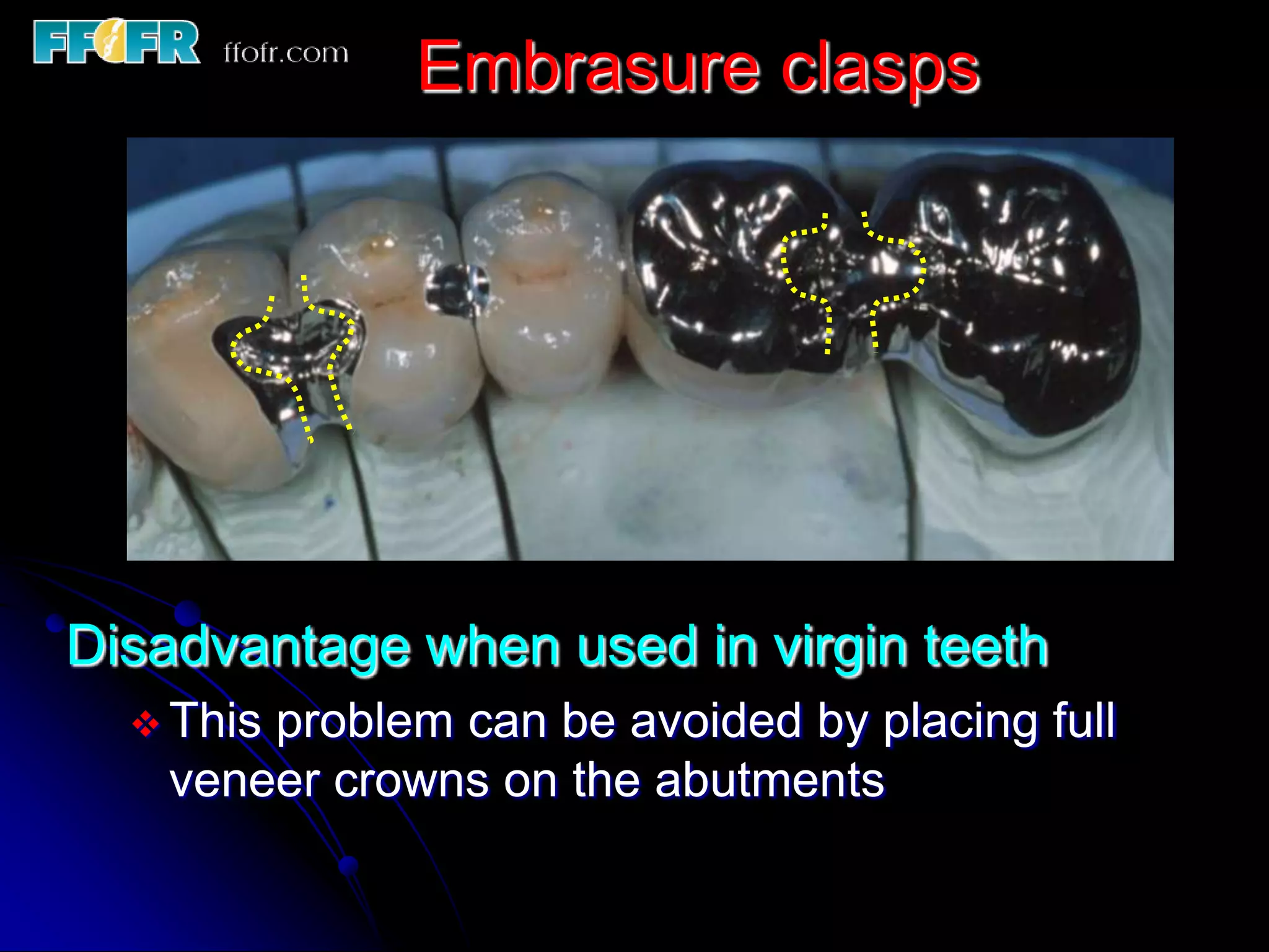 5.retainers, clasp assemblies and indirect retainers | PPT