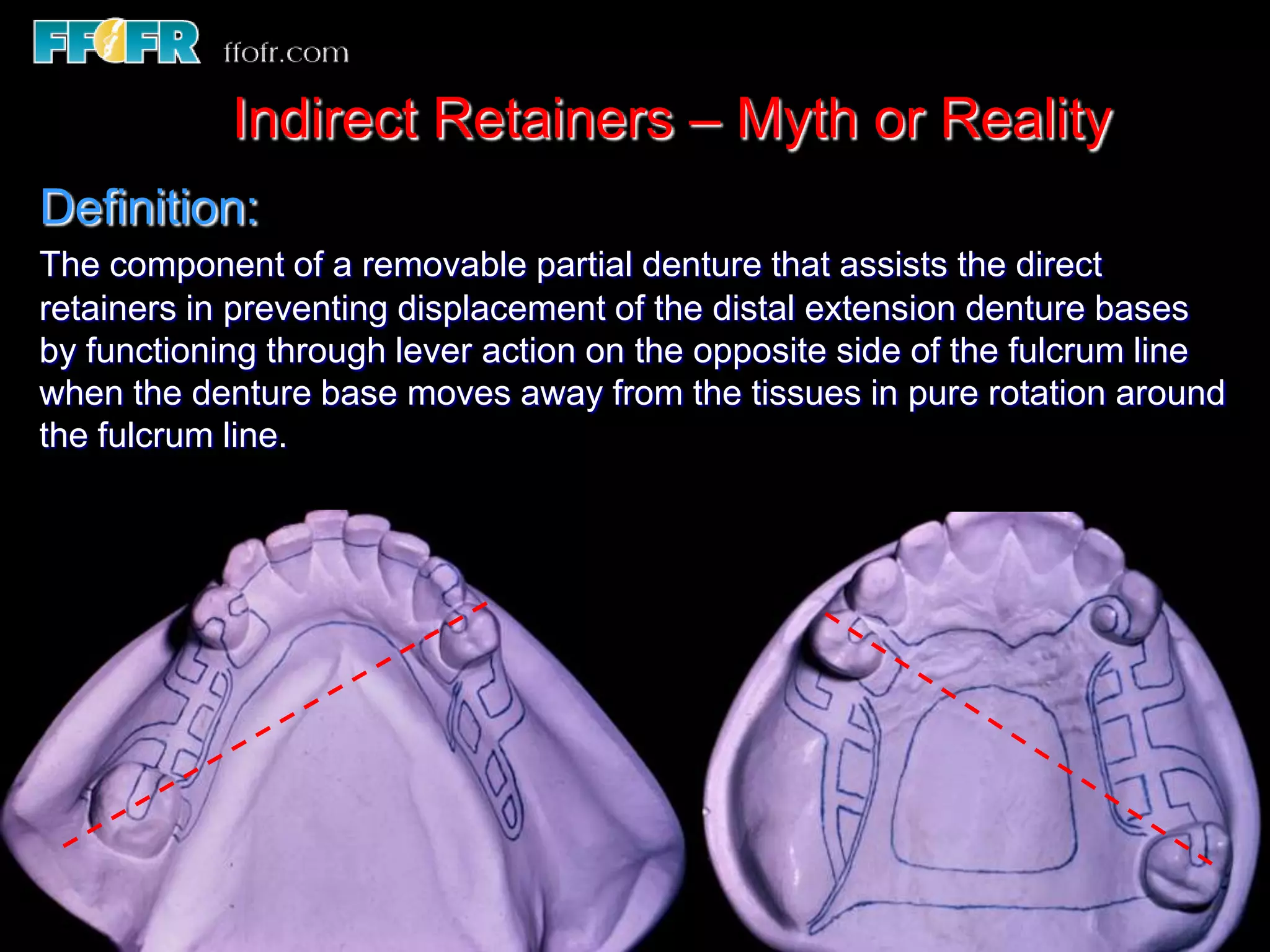 5.retainers, clasp assemblies and indirect retainers | PPT