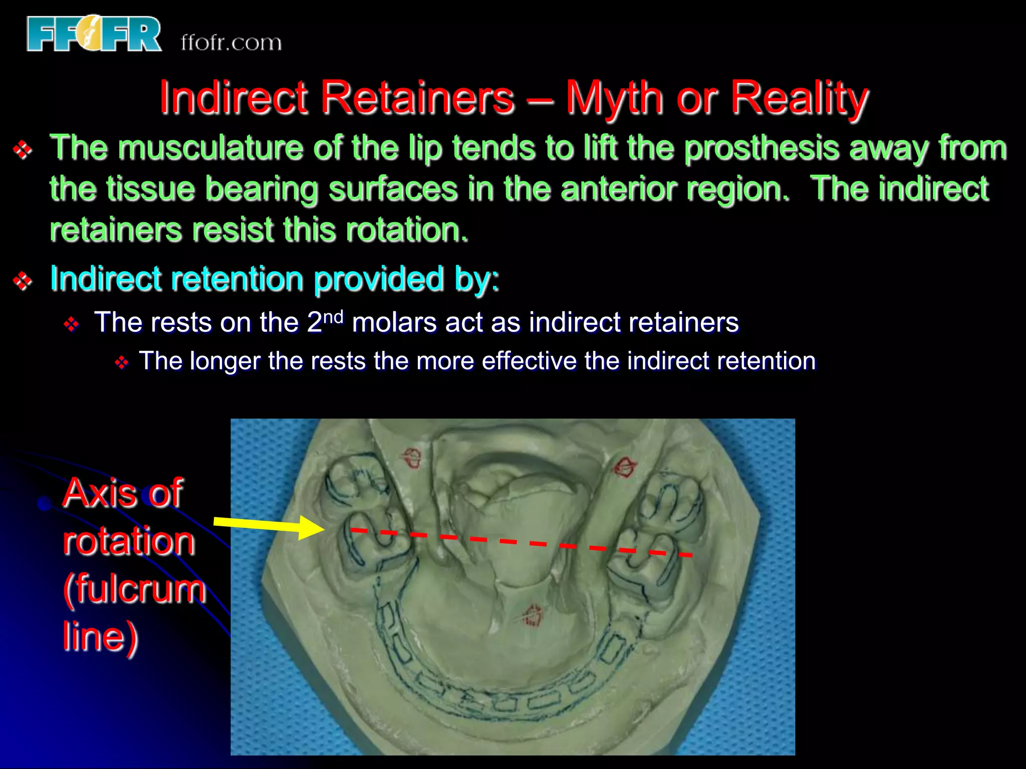 5.retainers, clasp assemblies and indirect retainers | PPT