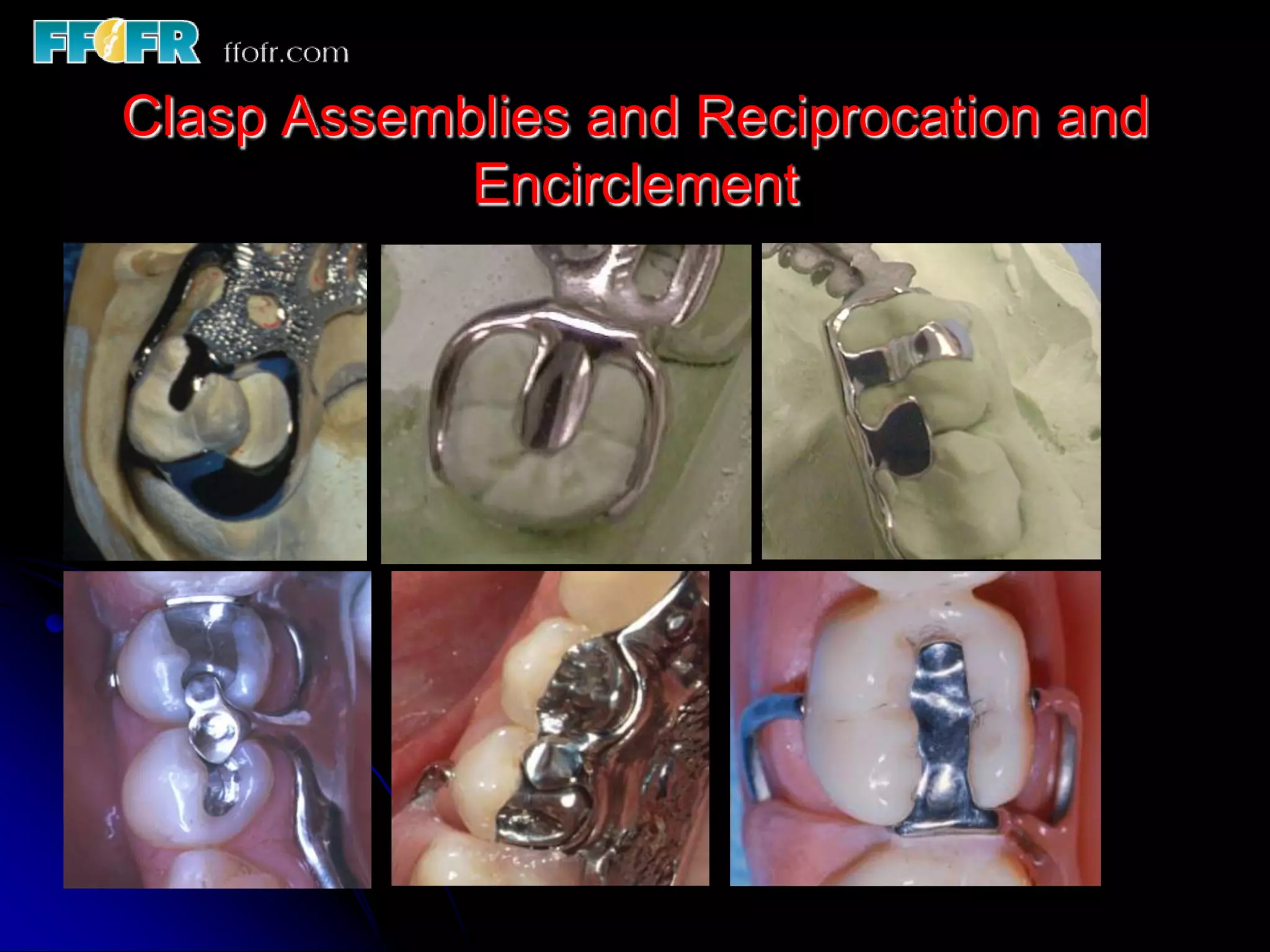 5.retainers, clasp assemblies and indirect retainers | PPT