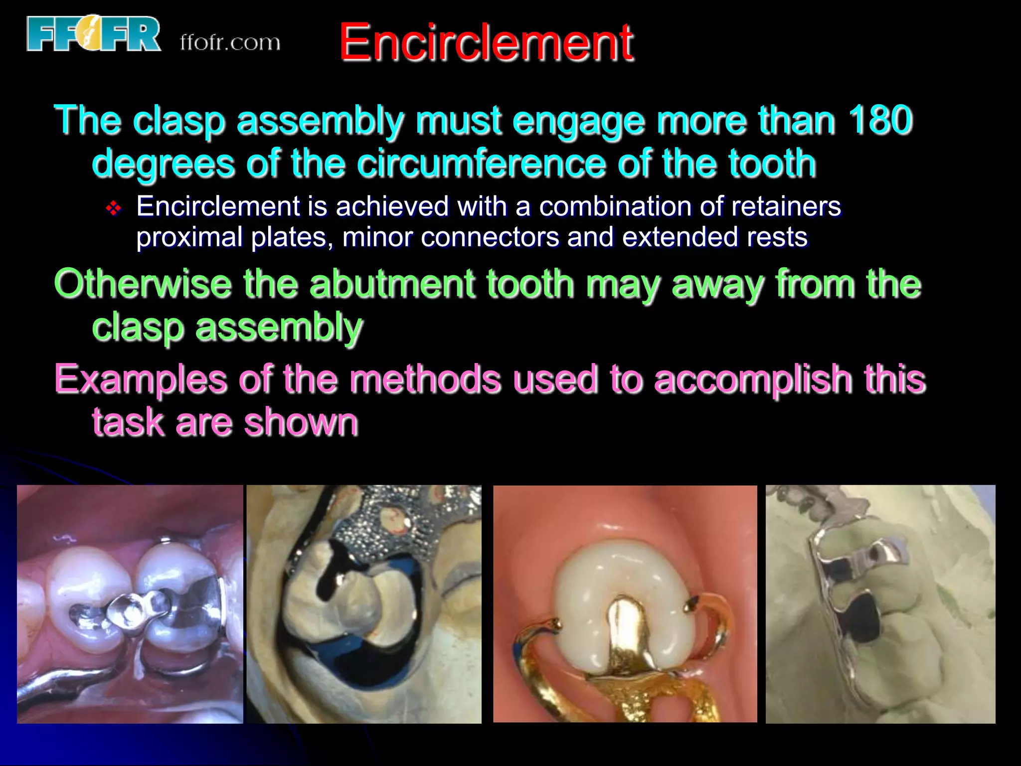 5.retainers, clasp assemblies and indirect retainers | PPT