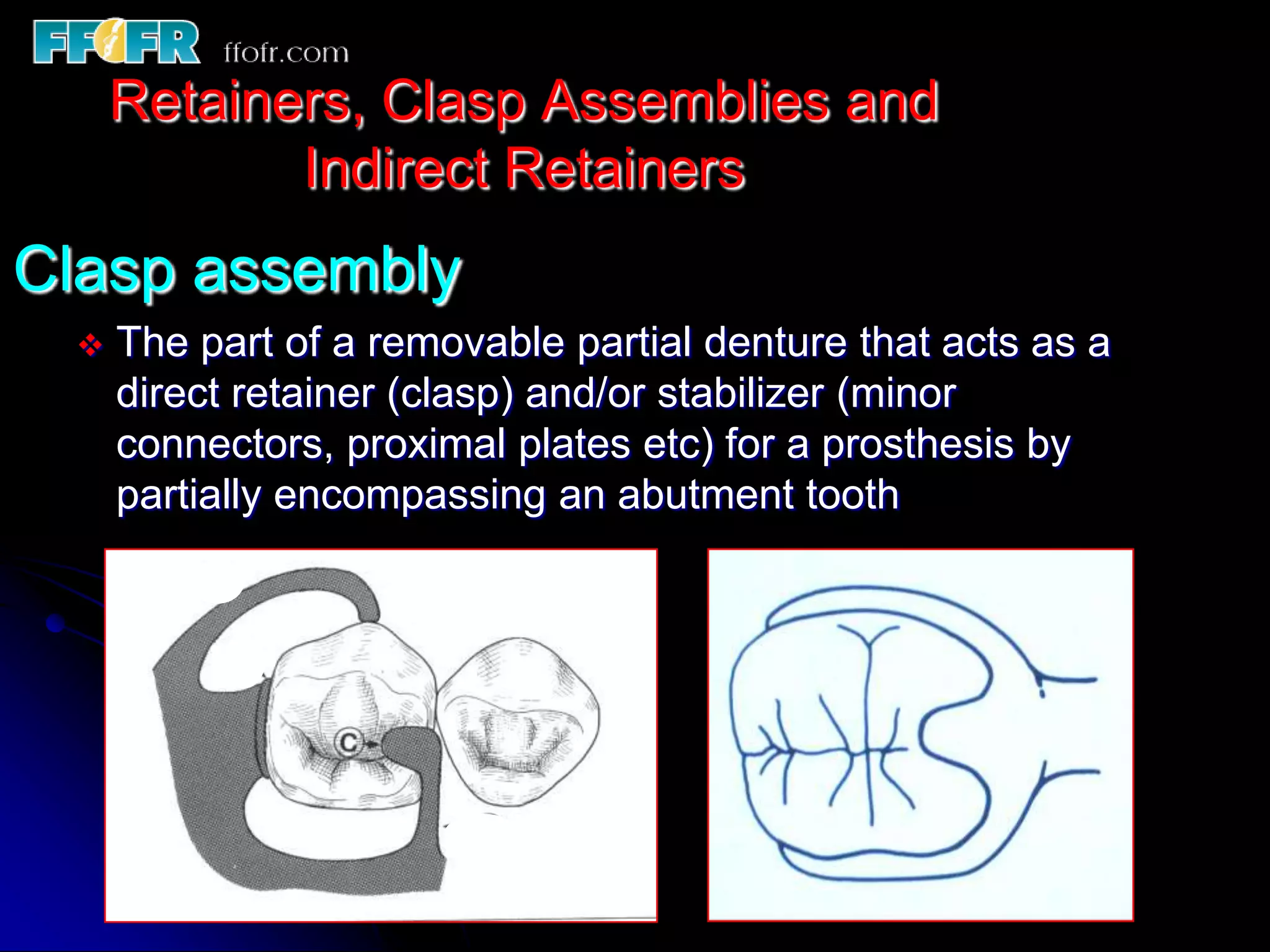 5.retainers, clasp assemblies and indirect retainers | PPT