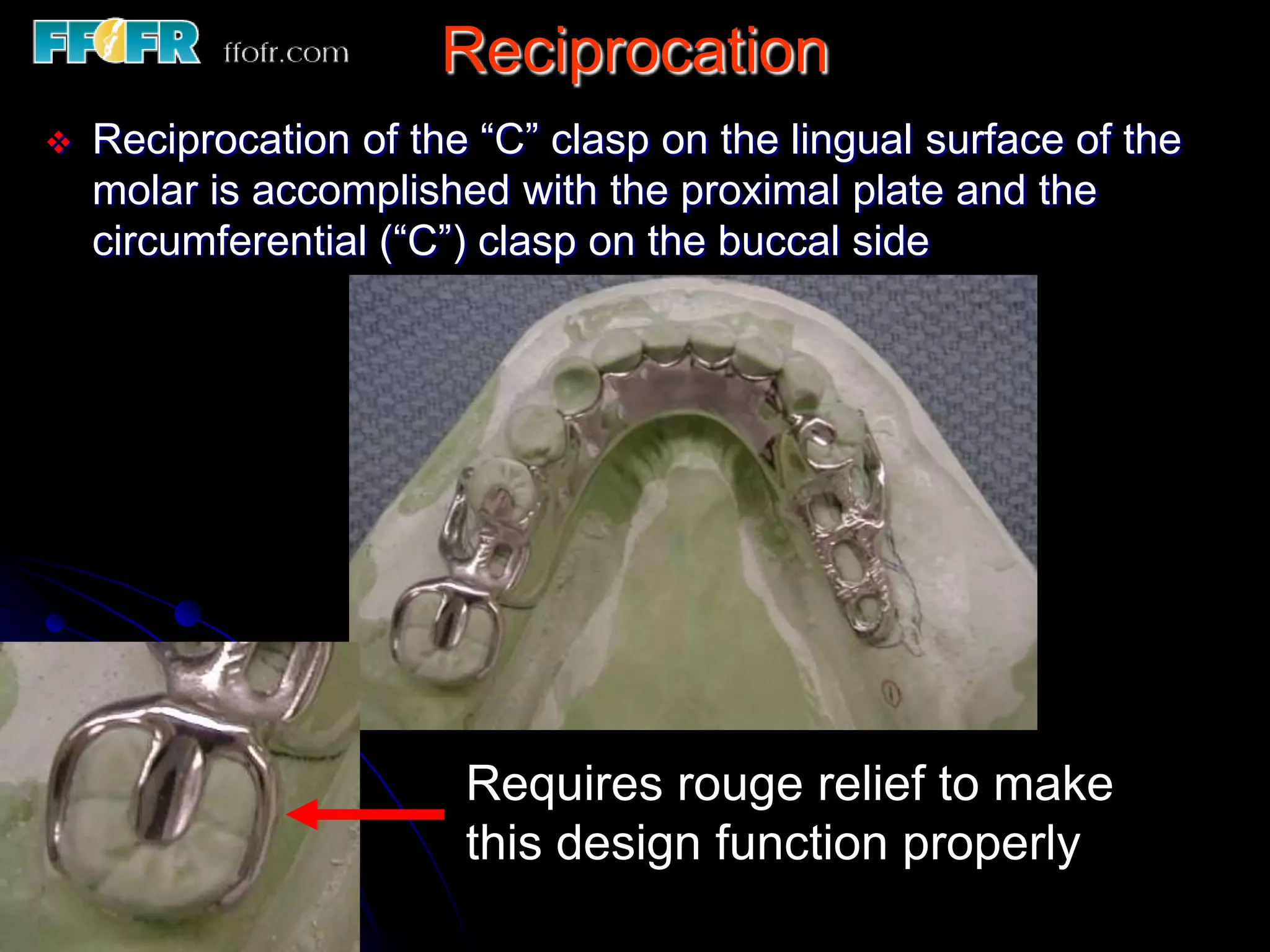 5.retainers, clasp assemblies and indirect retainers | PPT | Dental ...