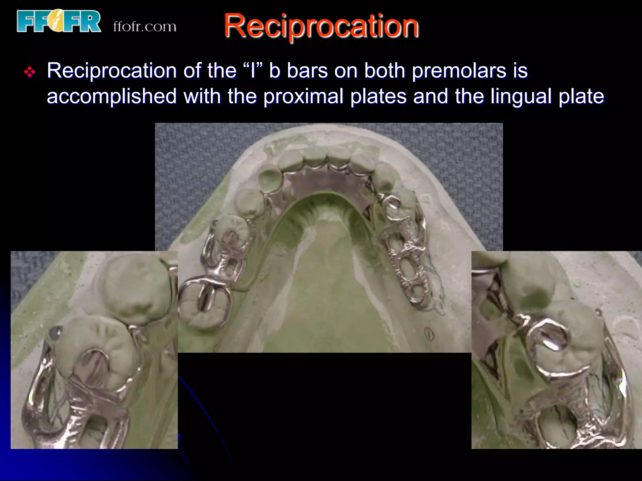5.retainers, clasp assemblies and indirect retainers | PPT