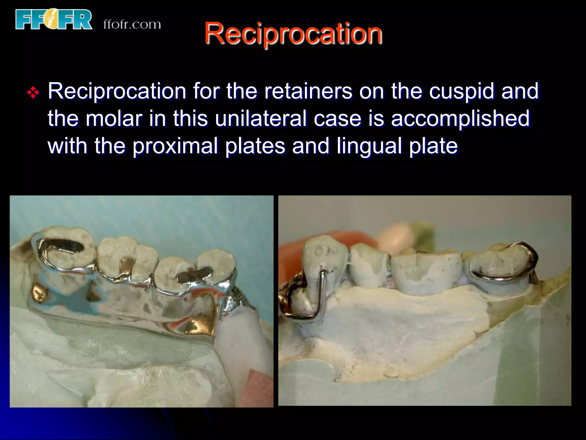 5.retainers, clasp assemblies and indirect retainers | PPT