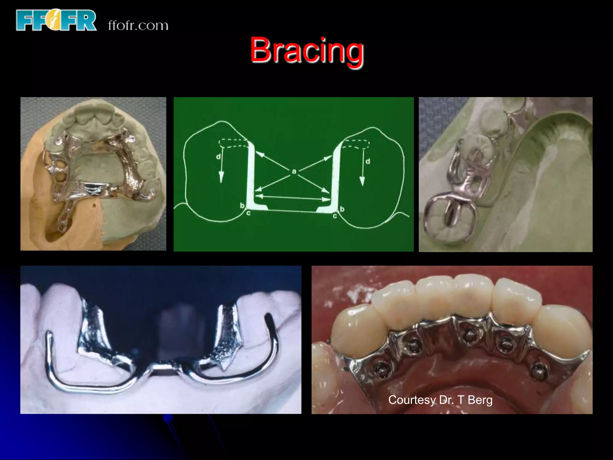 5.retainers, clasp assemblies and indirect retainers | PPT