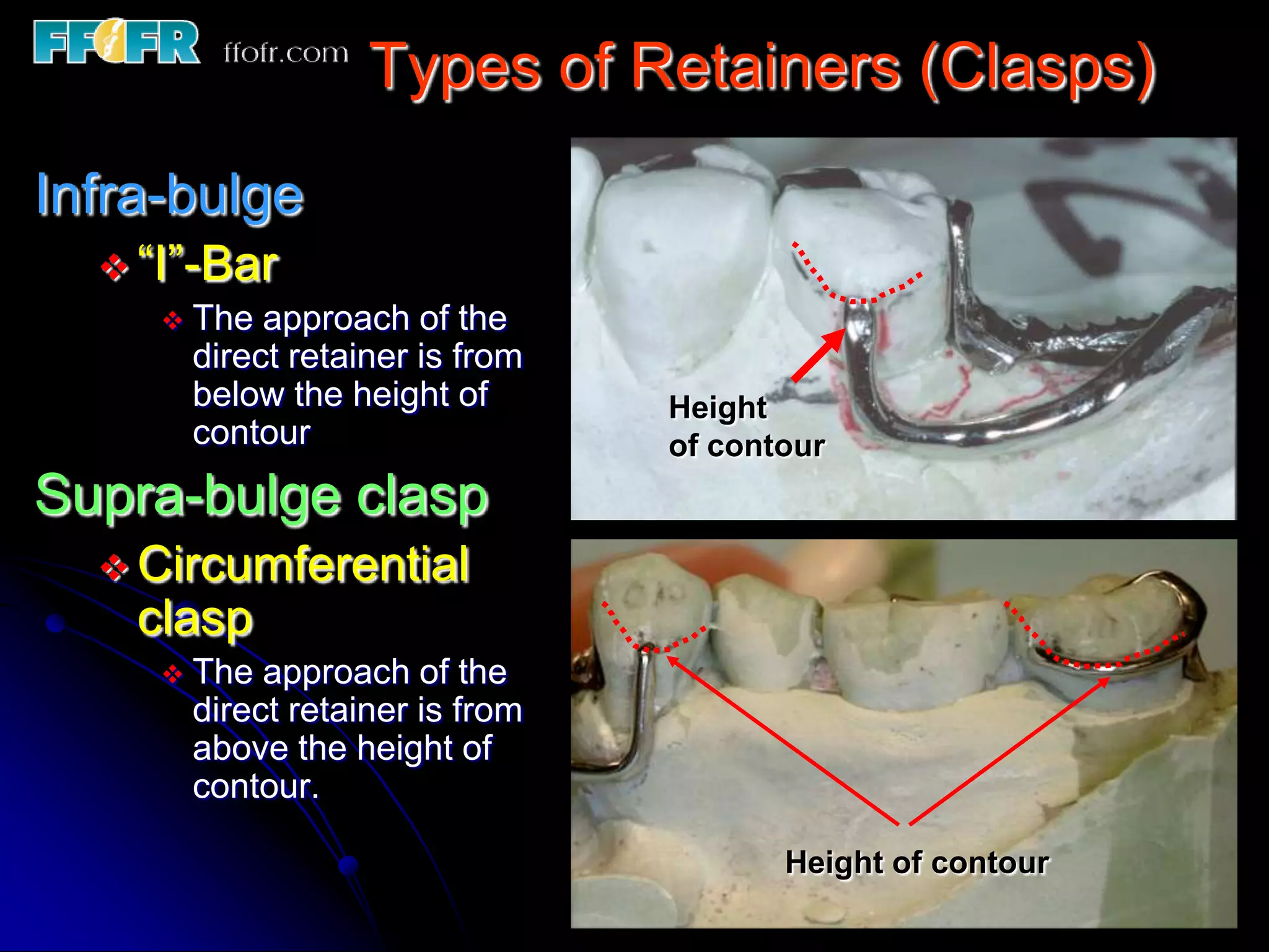 5.retainers, clasp assemblies and indirect retainers | PPT