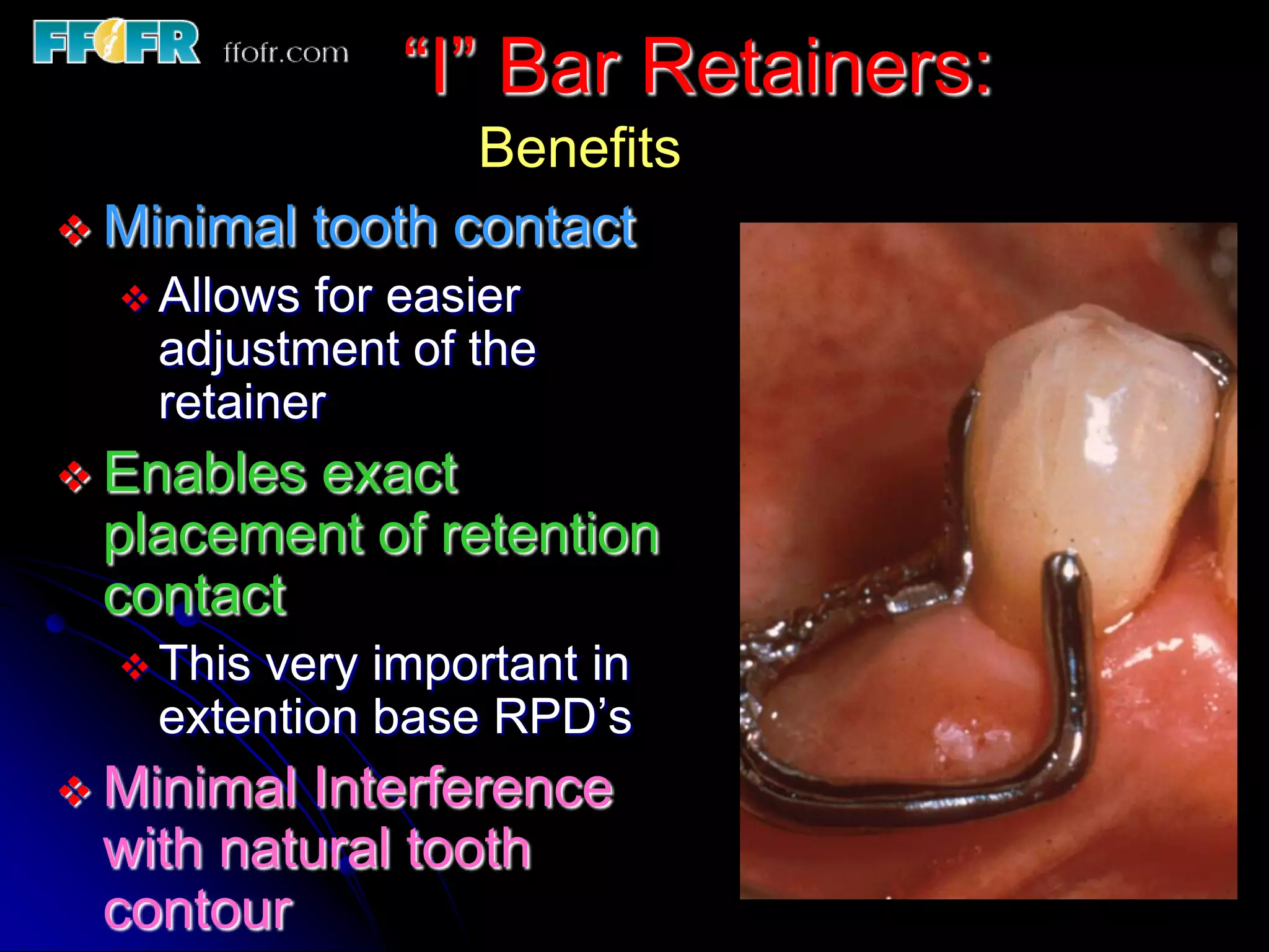 5.retainers, clasp assemblies and indirect retainers | PPT