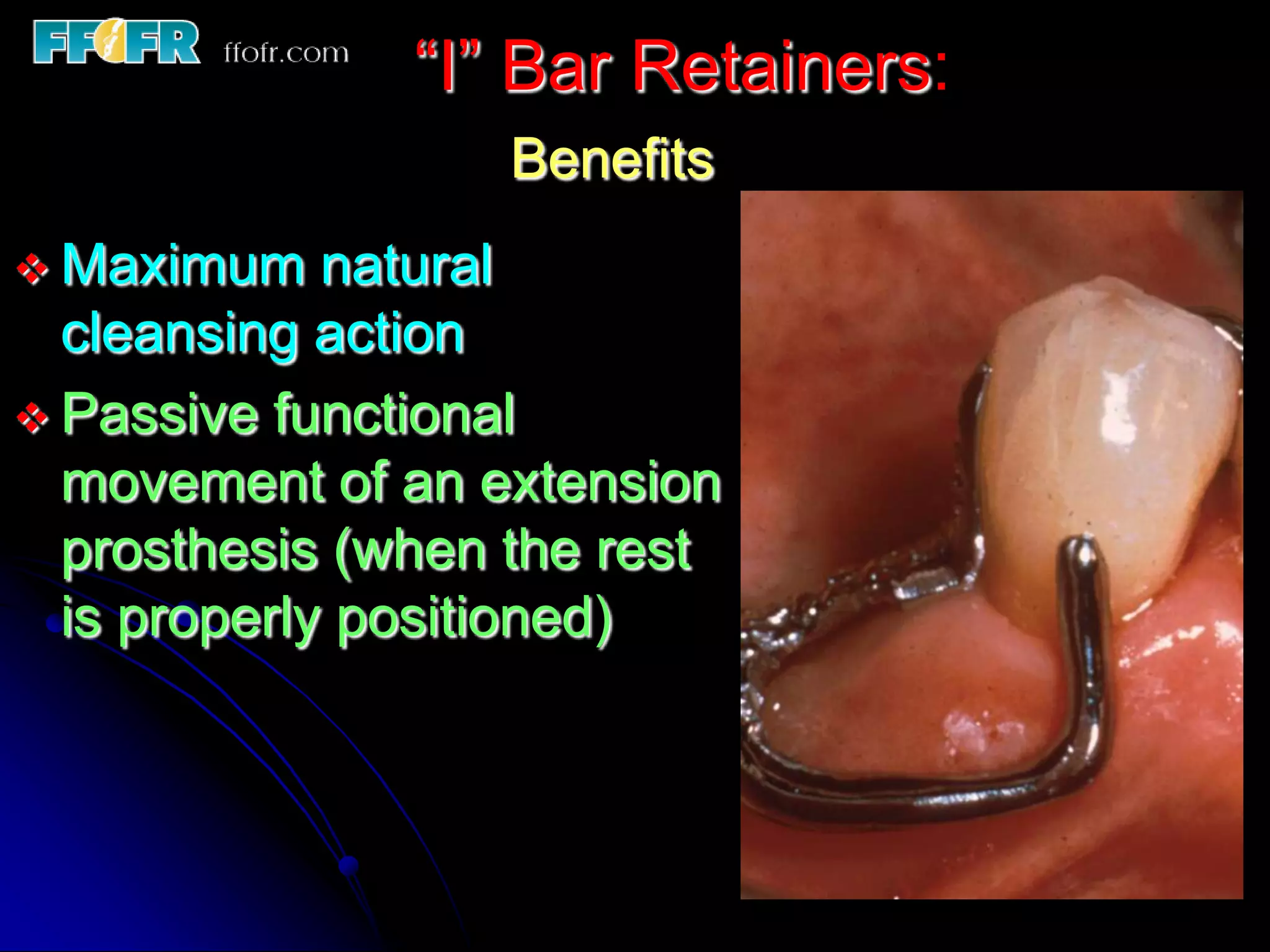 5.retainers, clasp assemblies and indirect retainers | PPT