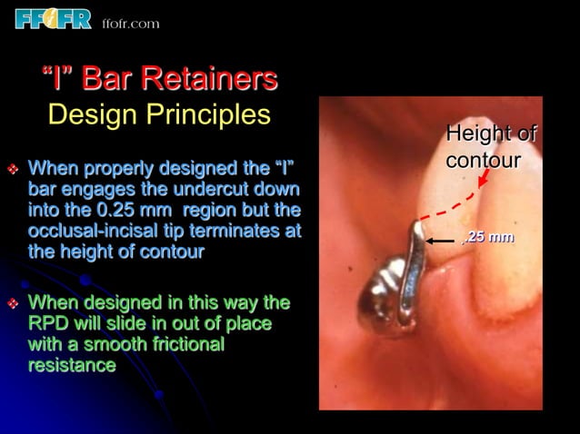 5.retainers, clasp assemblies and indirect retainers | PPT | Dental ...