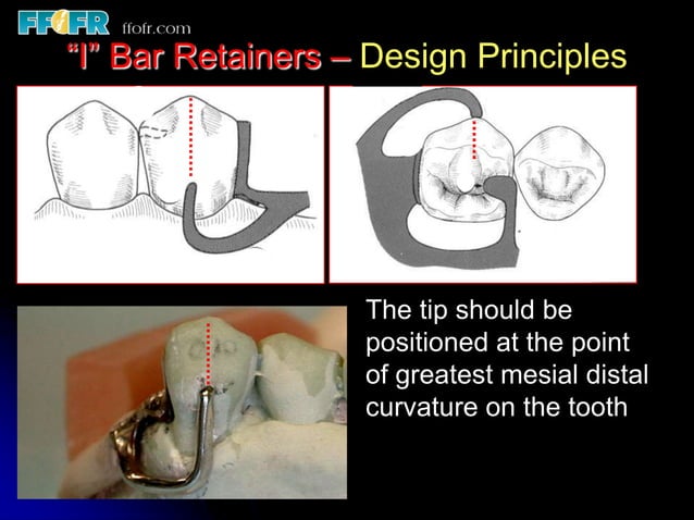 5.retainers, clasp assemblies and indirect retainers | PPT | Dental ...