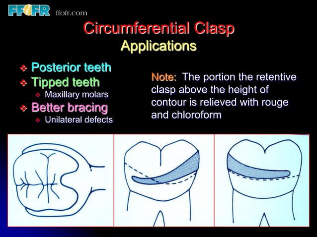 5.retainers, clasp assemblies and indirect retainers | PPT | Dental ...