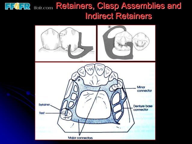 5.retainers, clasp assemblies and indirect retainers | PPT | Dental ...