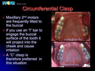 5.retainers, clasp assemblies and indirect retainers | PPT