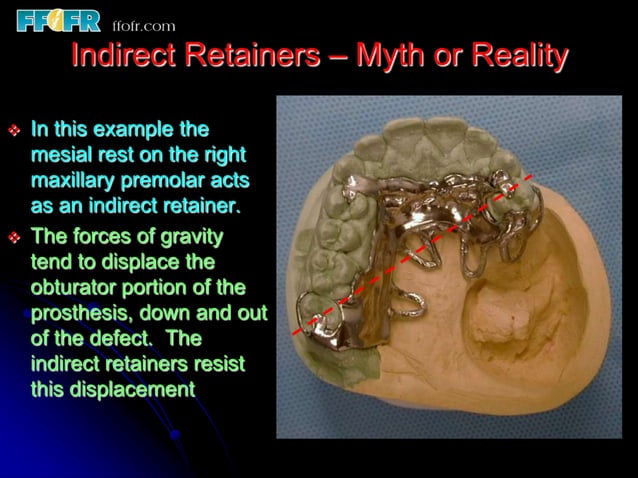 5.retainers, clasp assemblies and indirect retainers | PPT | Dental ...