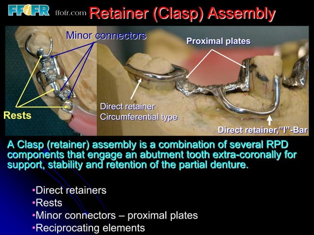 5.retainers, clasp assemblies and indirect retainers | PPT | Dental ...