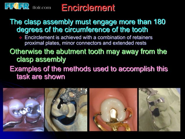 5.retainers, clasp assemblies and indirect retainers | PPT | Dental ...