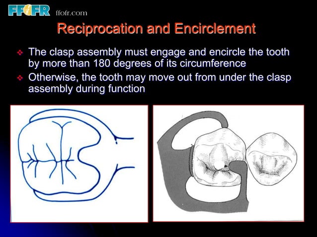 5.retainers, clasp assemblies and indirect retainers | PPT | Dental ...