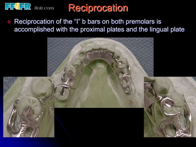 5.retainers, clasp assemblies and indirect retainers | PPT | Dental ...
