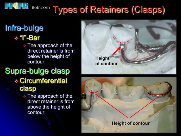 5.retainers, clasp assemblies and indirect retainers | PPT | Dental ...