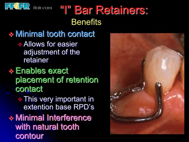 5.retainers, clasp assemblies and indirect retainers | PPT | Dental ...