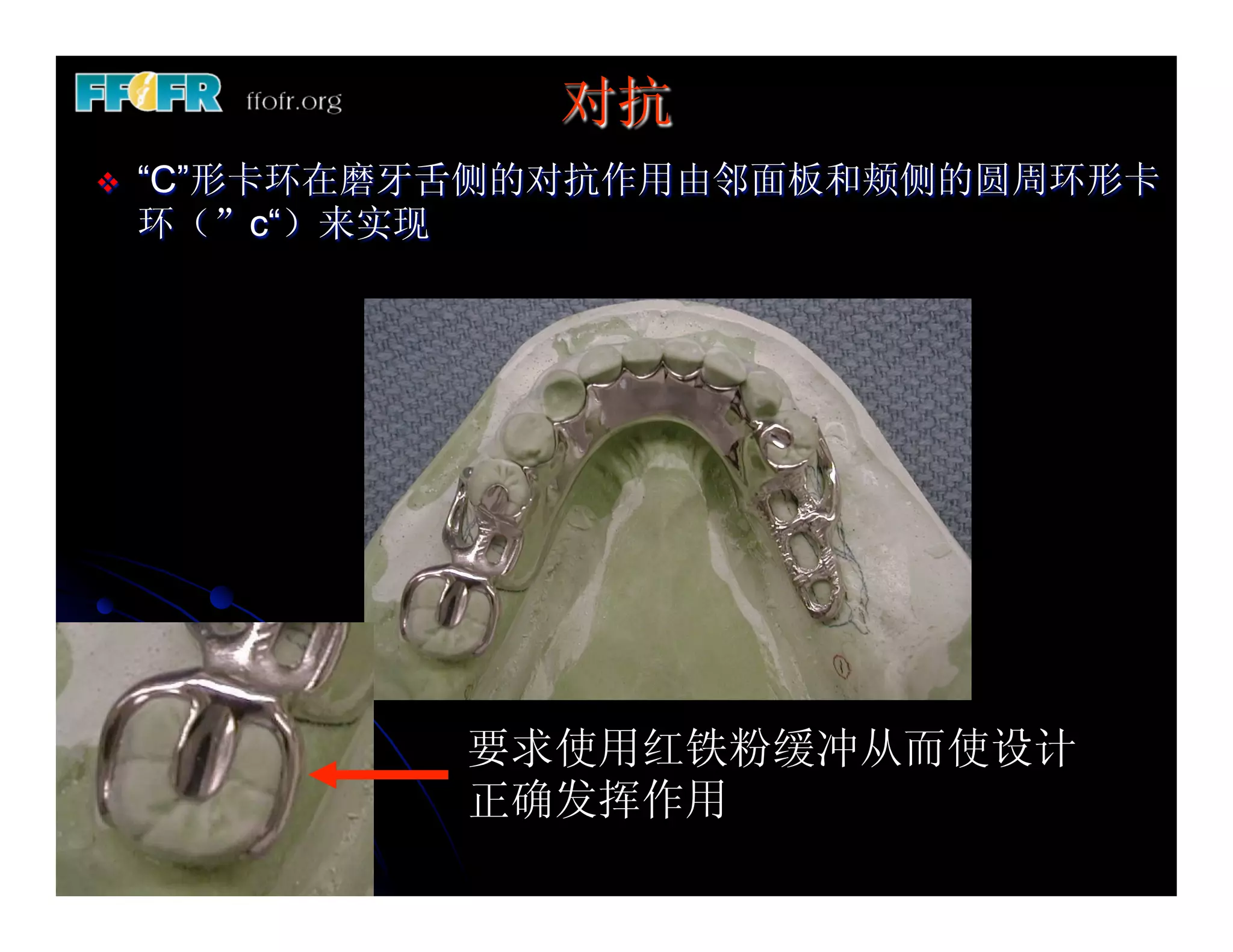 5.retainers, clasp assemblies and indirect retainers | PPT
