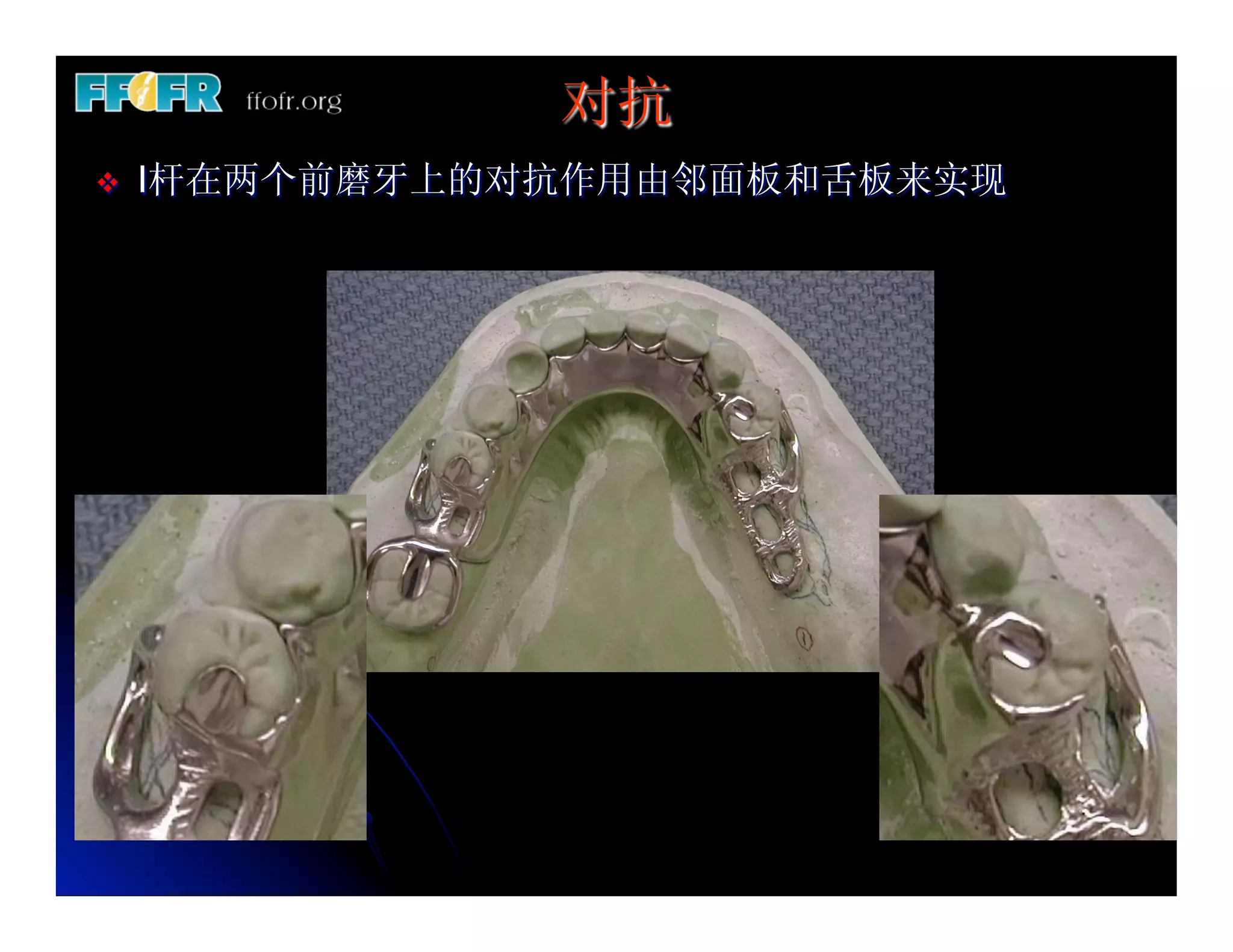 5.retainers, clasp assemblies and indirect retainers | PPT