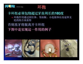 5.retainers, clasp assemblies and indirect retainers | PDF