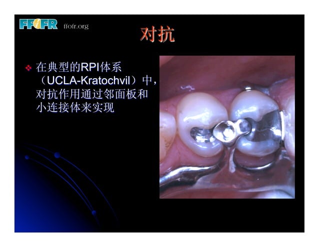 5.retainers, clasp assemblies and indirect retainers | PPT